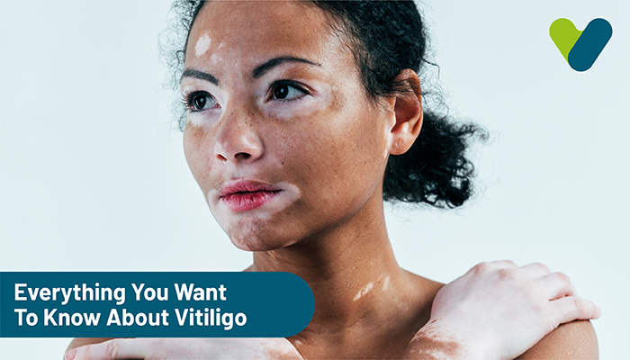 Vitiligo: Symptoms, Causes, Treatments & Types Of Vitiligo | Livlong